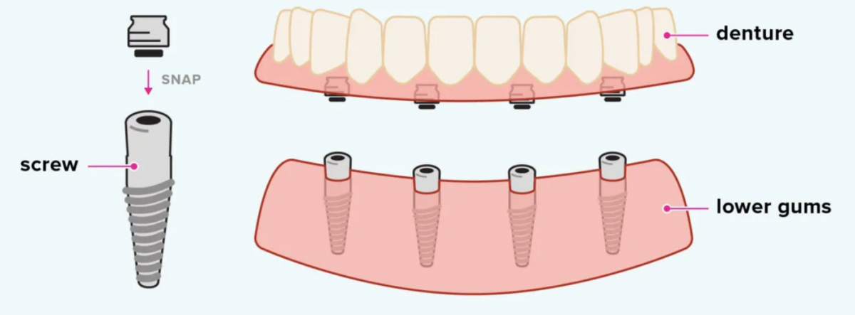 Snap-In Dentures - The Practice West End Dental