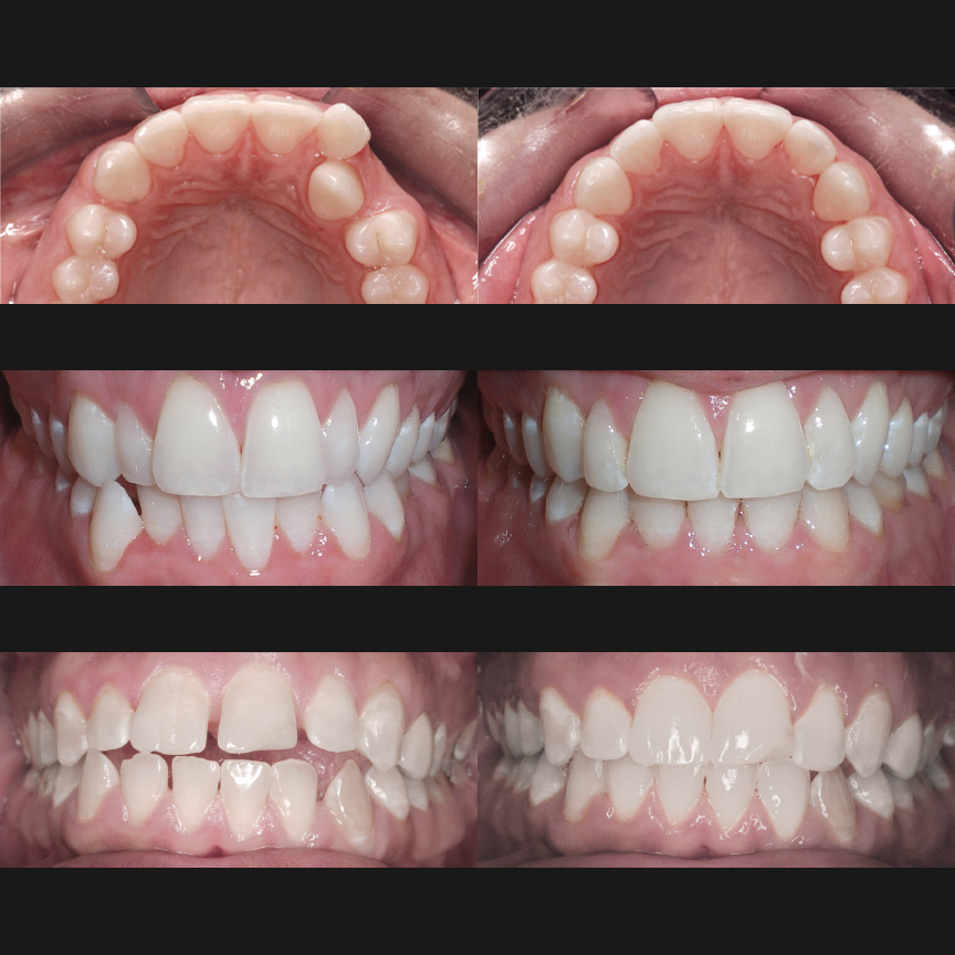 Clear Correct Clear Aligners At The Practice West End Brisbane