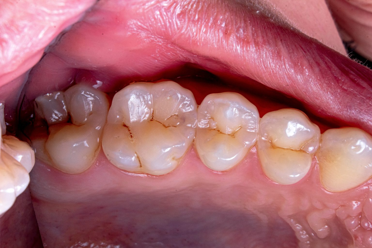 What really causes cavities? Top tips from our West End dentists